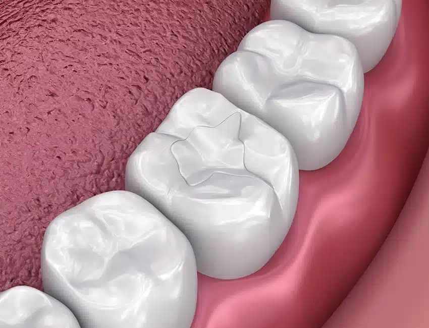 Dental Fillings in Borivali | Tooth Cavity Treatment by MDS Dentists