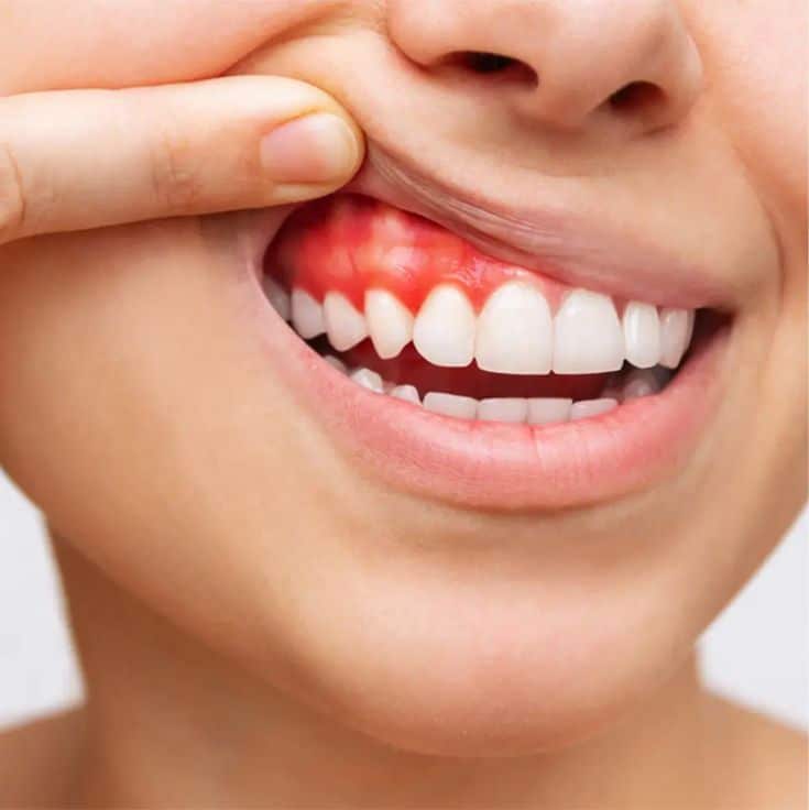 Gum Surgery in Borivali | Advanced Periodontal Treatment by MDS Dentists